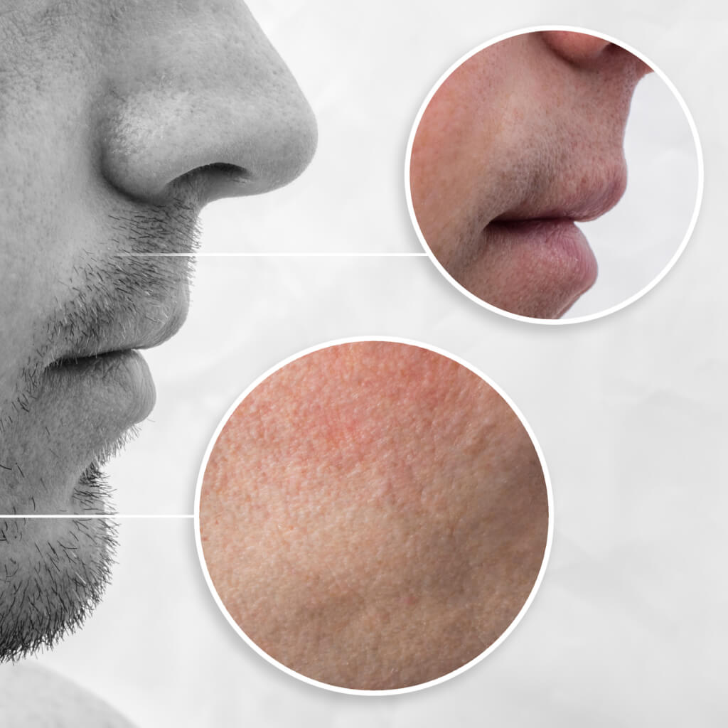 Beard Transplantation - Estefirst